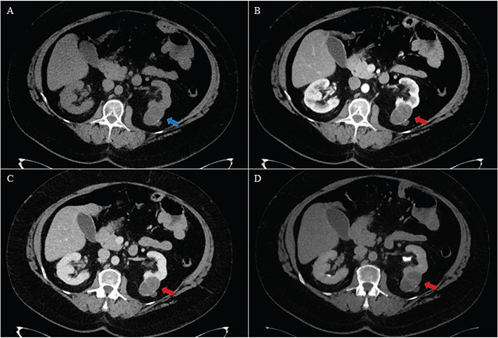 Computed tomography for visible haematuria – a single nephrographic ...