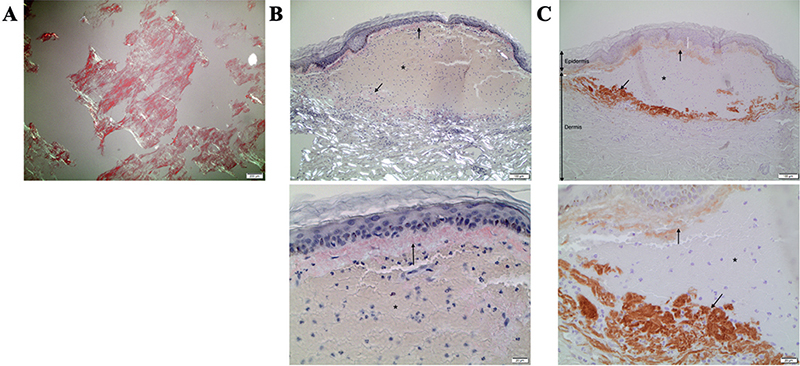 Extensive Amyloid Purpura: An Unusual Presentation of Myeloma ...