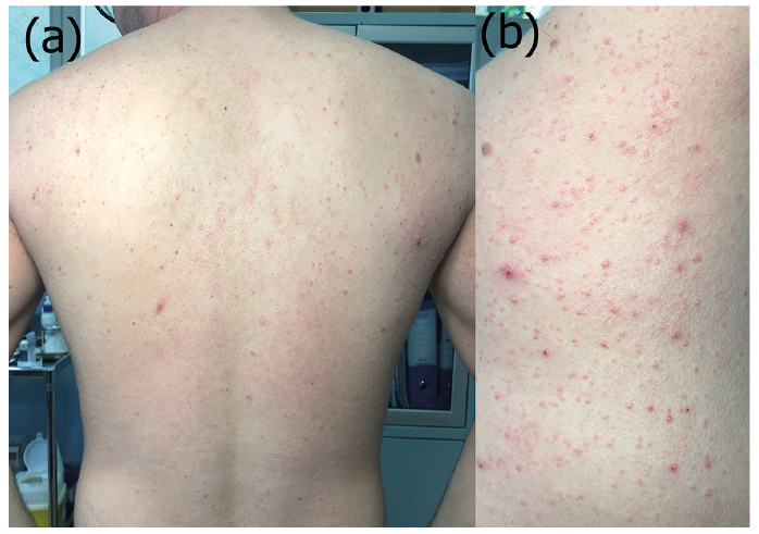 Fig. 1. Clinical photographs. (a) Extension of molluscum contagiosum ...