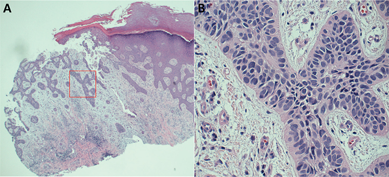 A Rare Case of Primary Cutaneous Basaloid Squamous Cell Carcinoma of ...