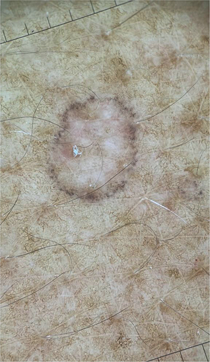 Annular Pigmented Macules on the Upper Trunk: A Quiz