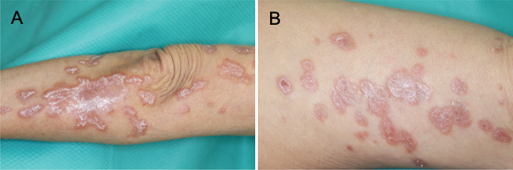 Multiple Erythematous Annular Scaly Plaques: A Quiz
