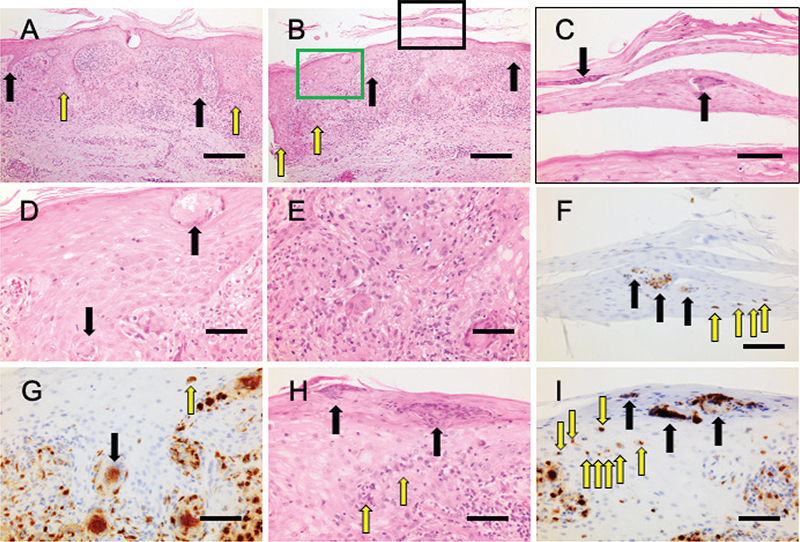 Multiple Erythematous Annular Scaly Plaques: A Quiz