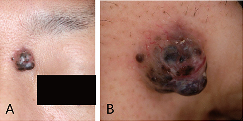 A Black Tumour on the Face with a Histological Rippled Pattern: A Quiz