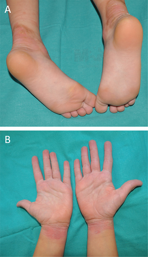 Keratoderma-hypotrichosis-leukonychia Totalis Syndrome: A New Case ...
