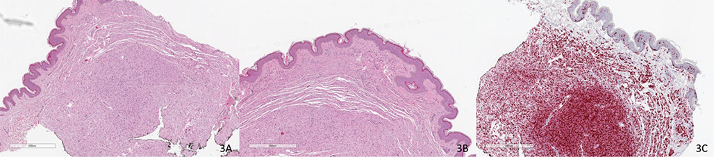 Multiple Papules and Nodules in a Dermatomal Distribution: A Quiz