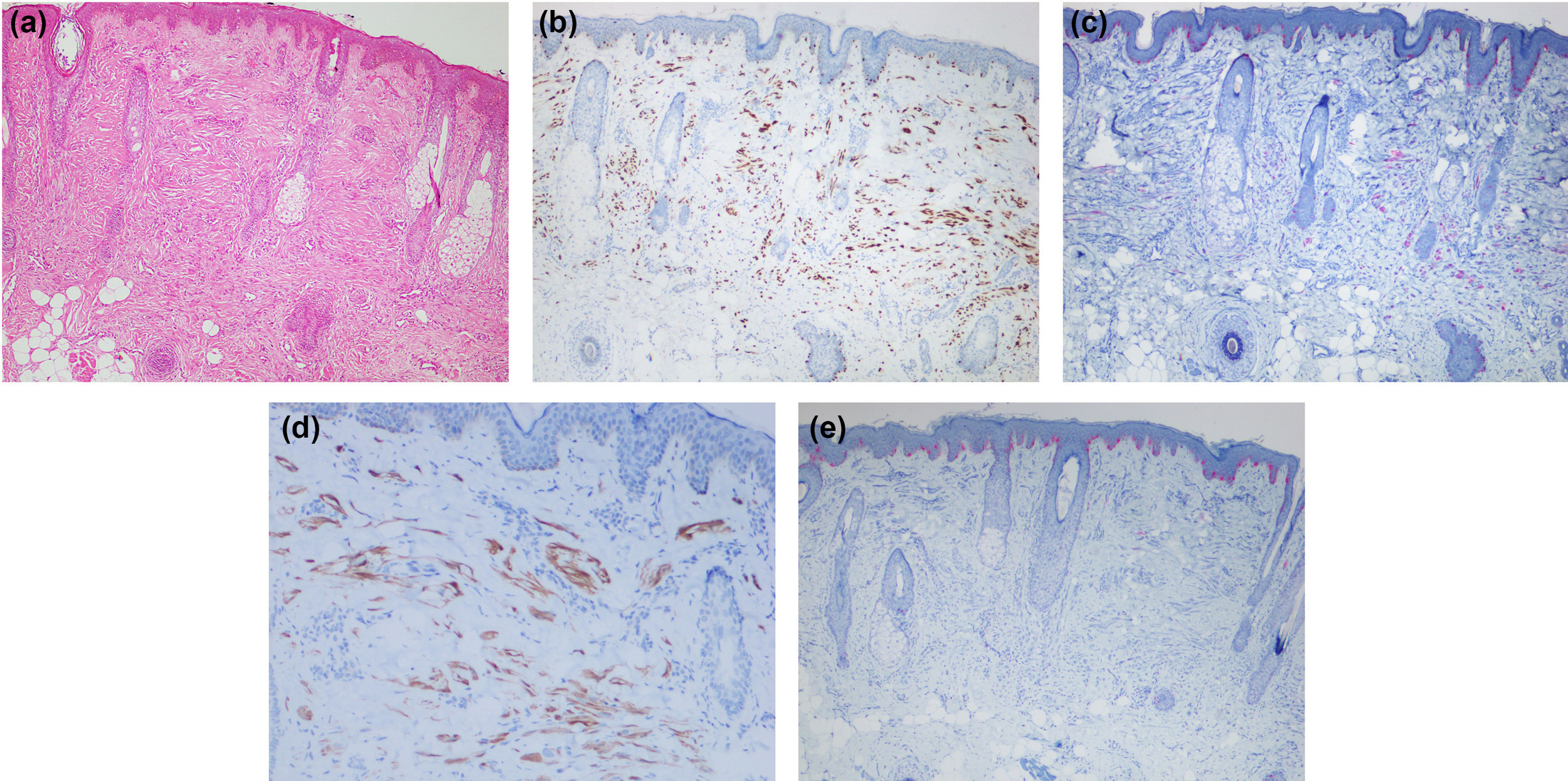 Desmoplastic Melanocytic Naevus in a Paediatric Patient: Dermoscopical ...