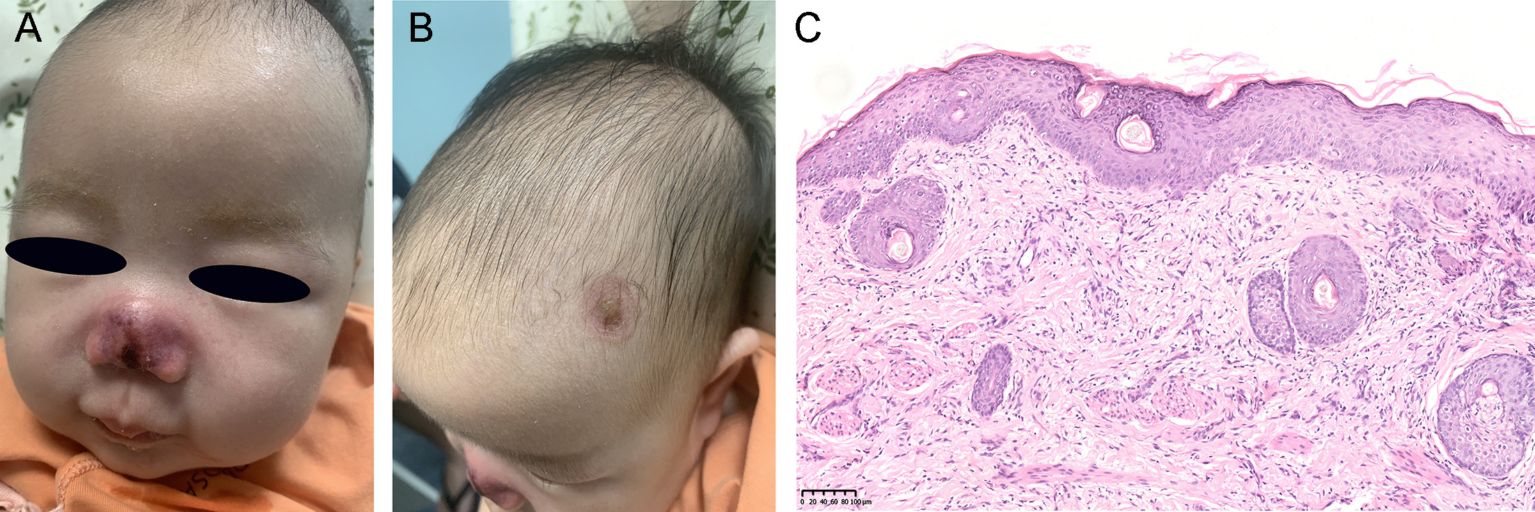 Nasal Plaque with Central Eschar in an Infant: A Quiz