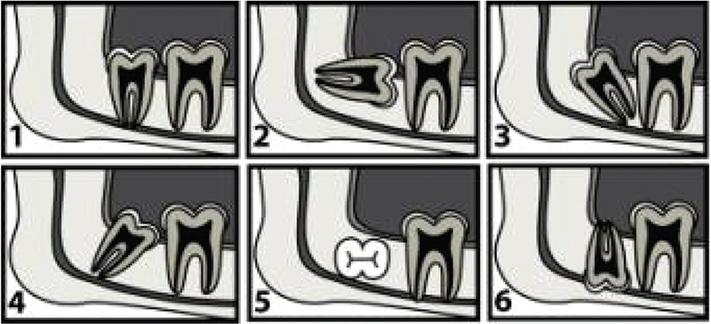 Assessing position changes of impacted third molars in treatment of ...