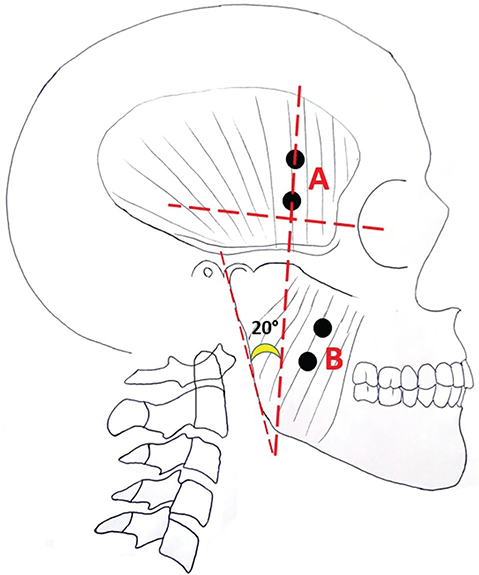 Changes in the electromyographic activity of masticatory muscles in ...