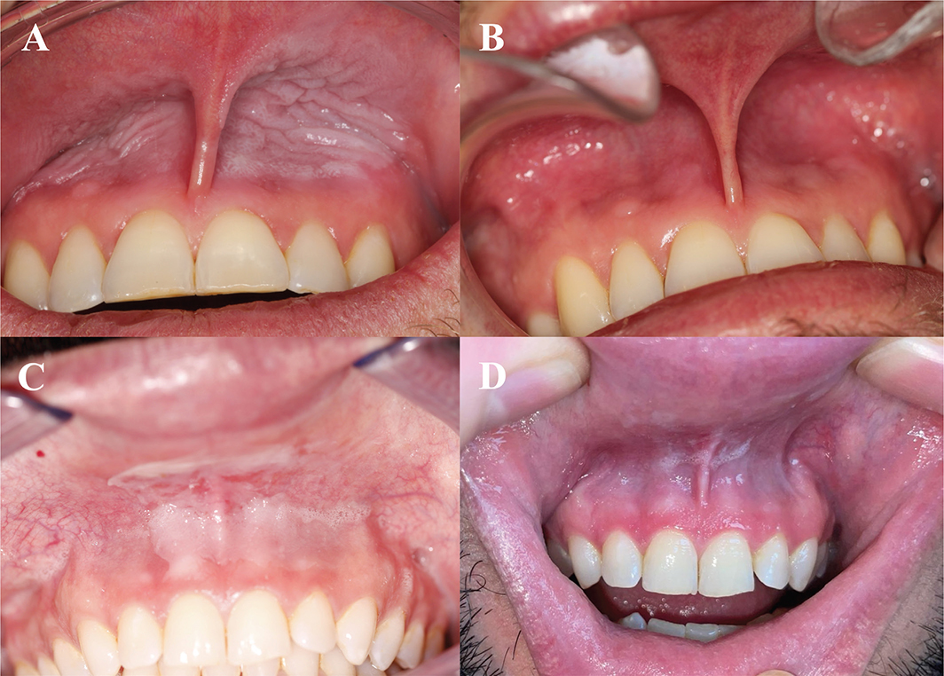 Self-reported oral health outcomes after switching to a novel nicotine ...