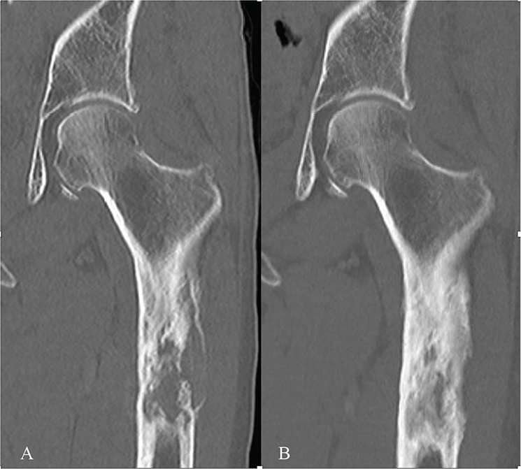 Denosumab combined with radiotherapy as an alternative to surgery for ...